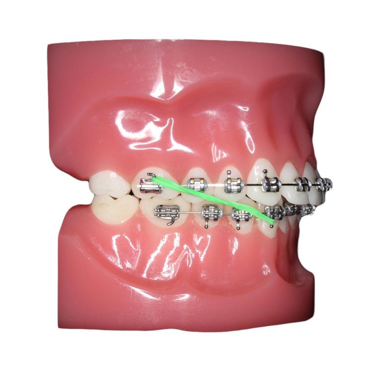 Rubberbands | Orthodontics Daphne | Glass Orthodontics