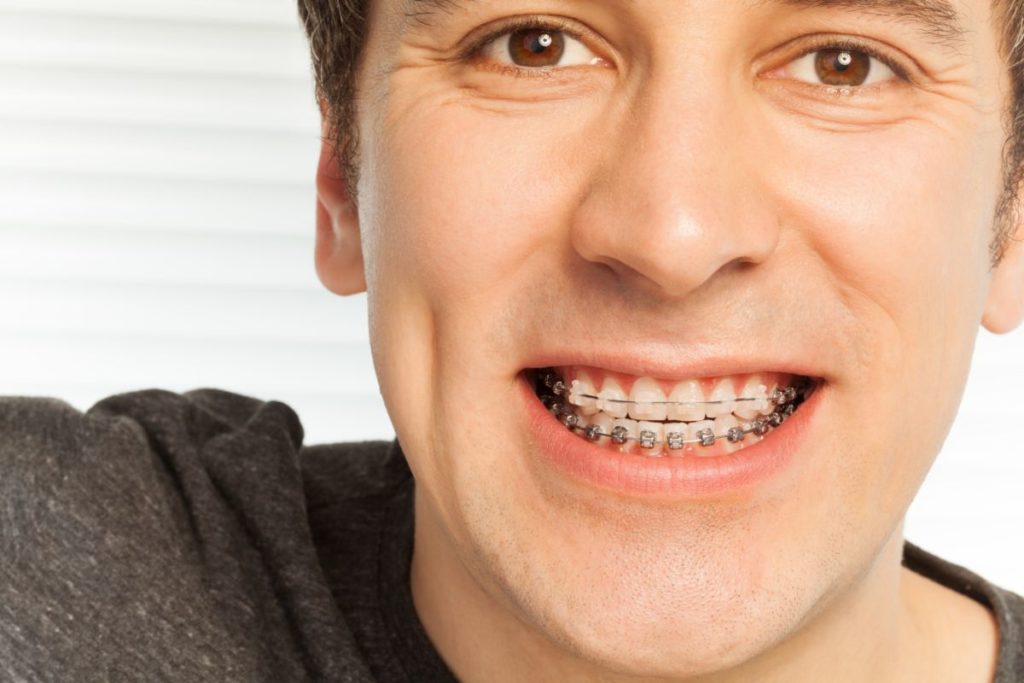 The Different Types of Braces | Glass Orthodontics